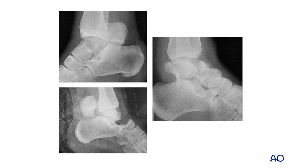 Talar neck fractures and complications AO Trauma Advanced