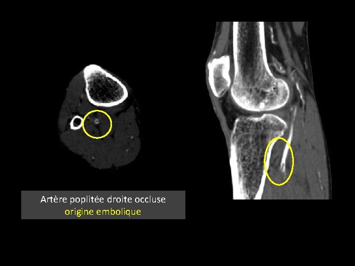 Patient de 73 ans Douleur intense du membre
