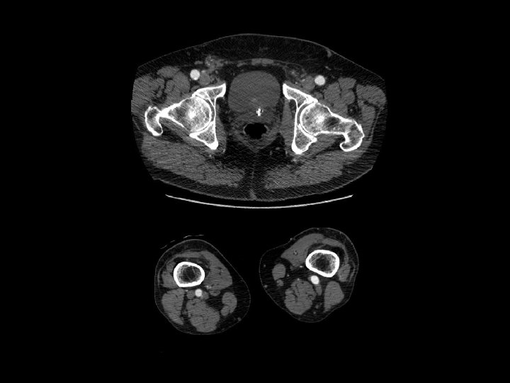 Patient de 73 ans Douleur intense du membre