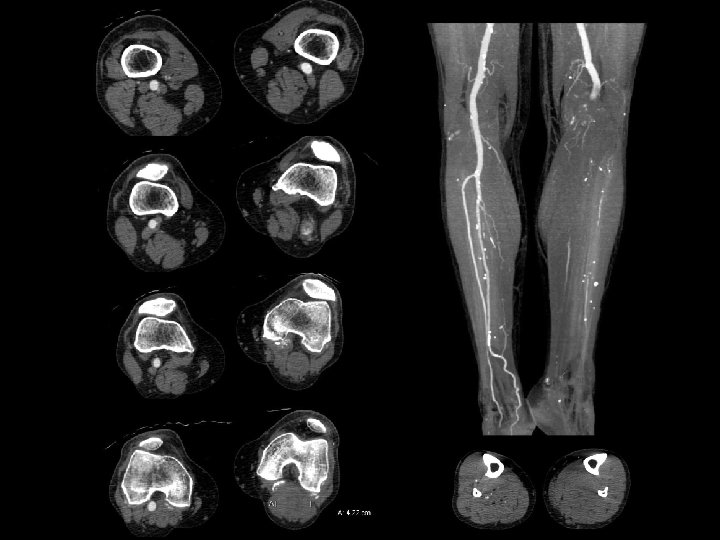 Patient de 73 ans Douleur intense du membre