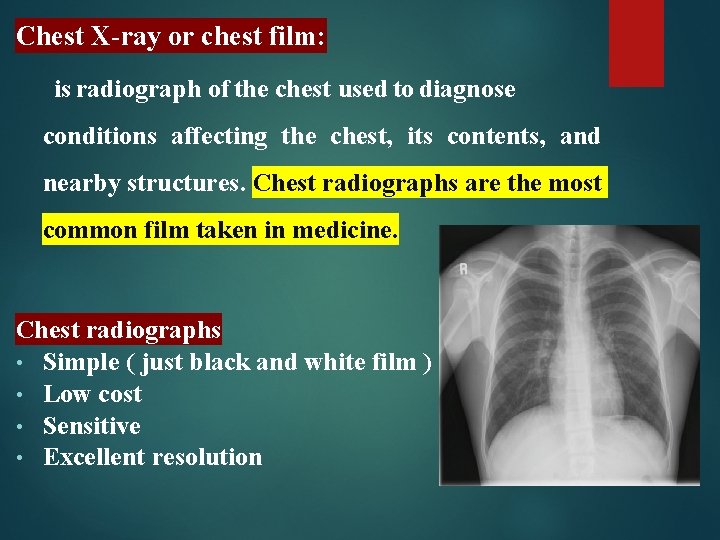 Chest xray HOW TO INTERPRET CHEST XRAY By