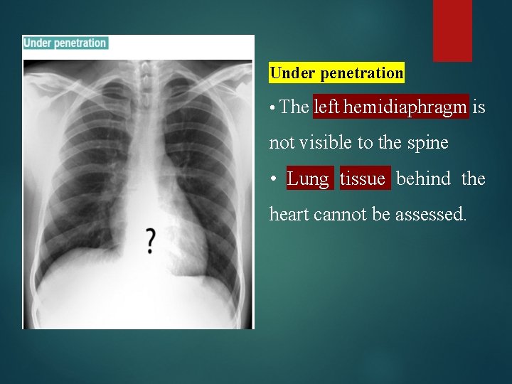 Chest xray HOW TO INTERPRET CHEST XRAY By