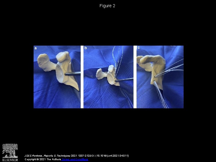 Radiological outcomes of iliac crest bone graft augmentation