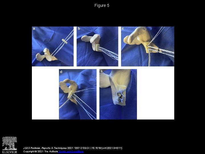 Radiological outcomes of iliac crest bone graft augmentation