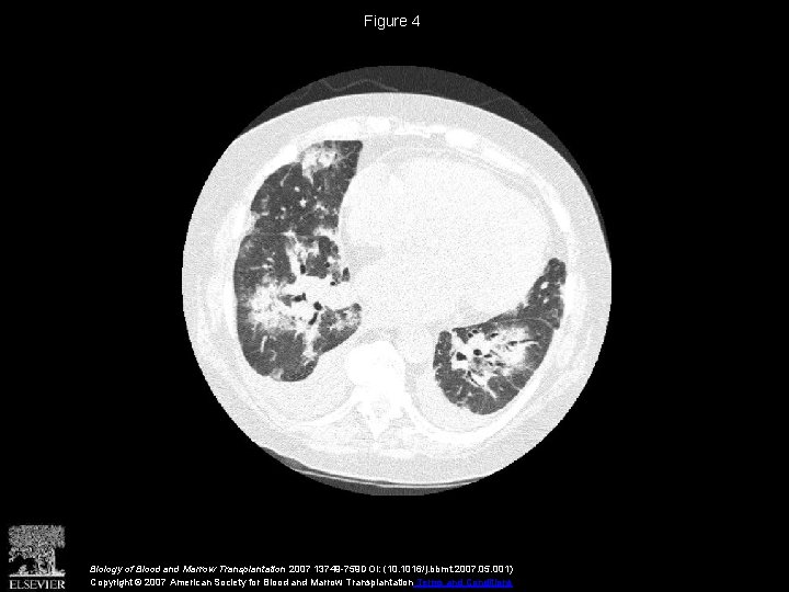 Bronchiolitis Obliterans Syndrome BOS Bronchiolitis Obliterans ...