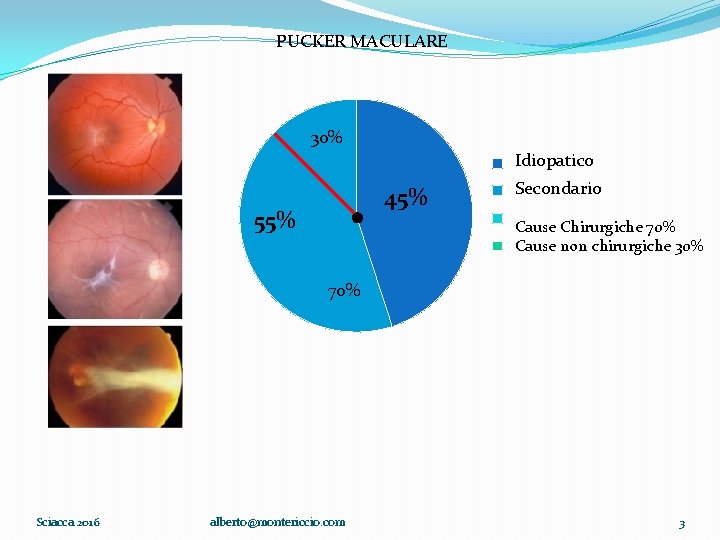 Patologie dellinterfaccia Vitreoretinica Indicazione Chirurgiche ...