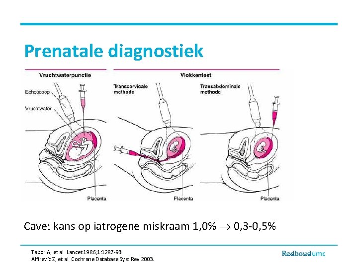 Klinische implementatie NIPT Lean Beulen AIOS Verloskunde en