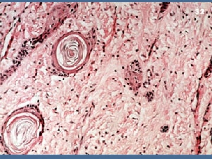 Odontogenic Keratocyst primordial cyst Odontogenic Keratocyst n Peak