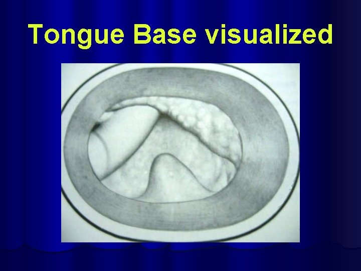 Aerodigestive Endoscopy Dr Vishal Sharma History l Bozzini