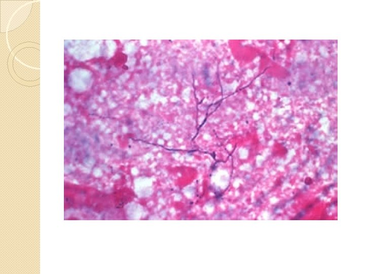 ACTINOMYCOSIS Actinomyces Are gram positive anaerobic nonacidfast rods
