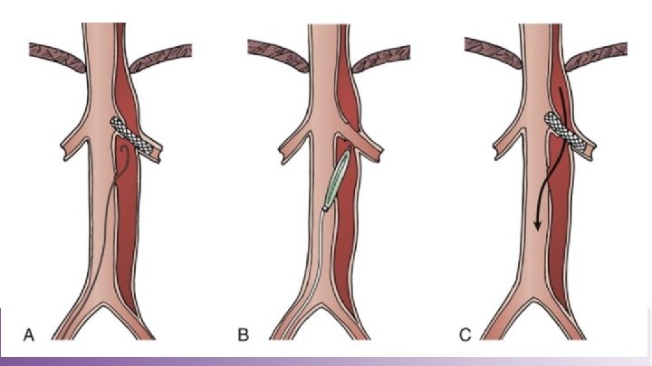 Treatment Approaches for Type B Aortic Dissection What