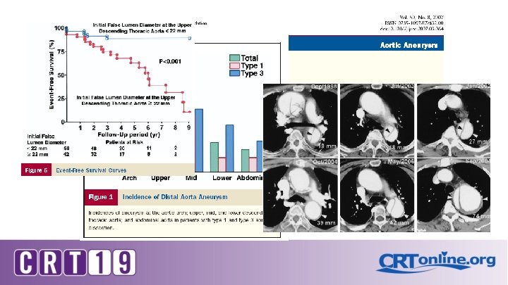 Treatment Approaches for Type B Aortic Dissection What