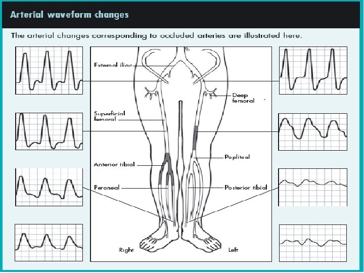 ARTERIAL ULCERS INTRODUCTION Arterial ulcers also referred to