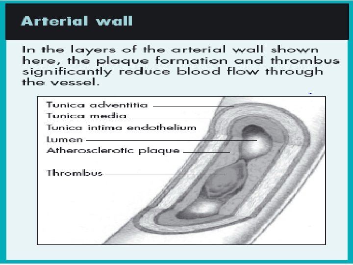 ARTERIAL ULCERS INTRODUCTION Arterial ulcers also referred to