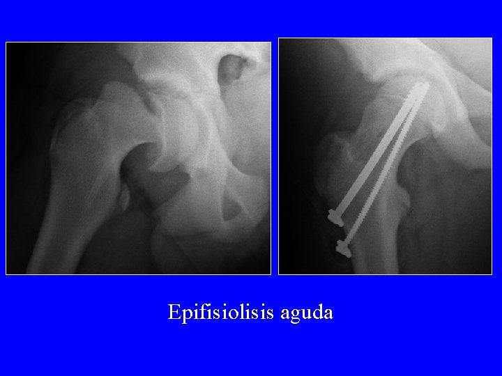 Epifisiolisis de la Cadera Desplazamiento progresivo o rpido