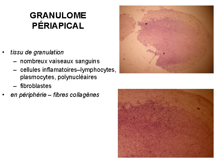 GRANULOME PRIAPICAL tissu de granulation nombreux vaiseaux sanguins
