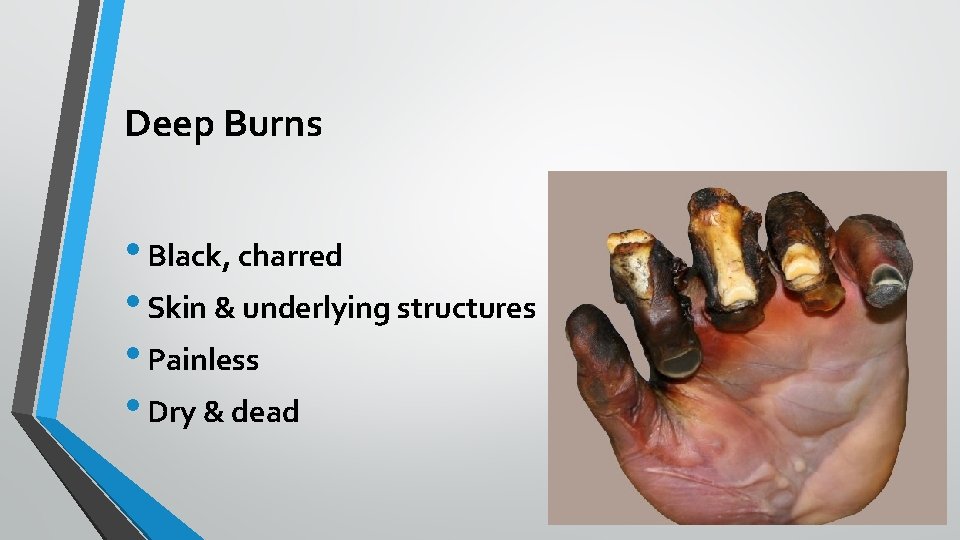 The Initial Assessment and Management of Burns Mr