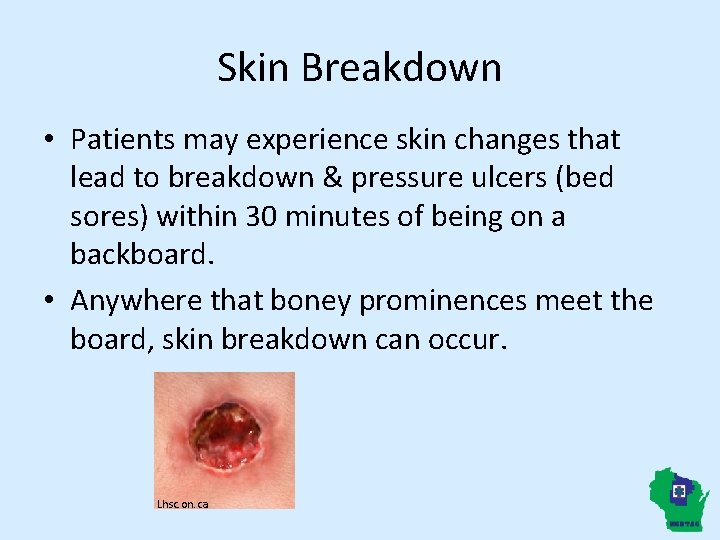 Reducing Pain and Skin Breakdown from Spinal Immobilization
