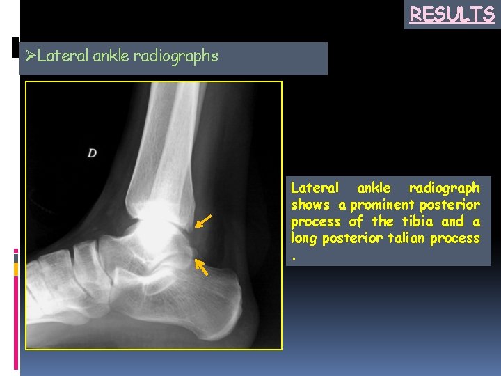 POSTERIOR IMPINGEMENT SYNDROME A CASE REPORT J BEN