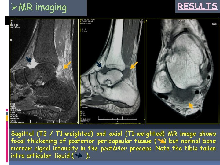 POSTERIOR IMPINGEMENT SYNDROME A CASE REPORT J BEN