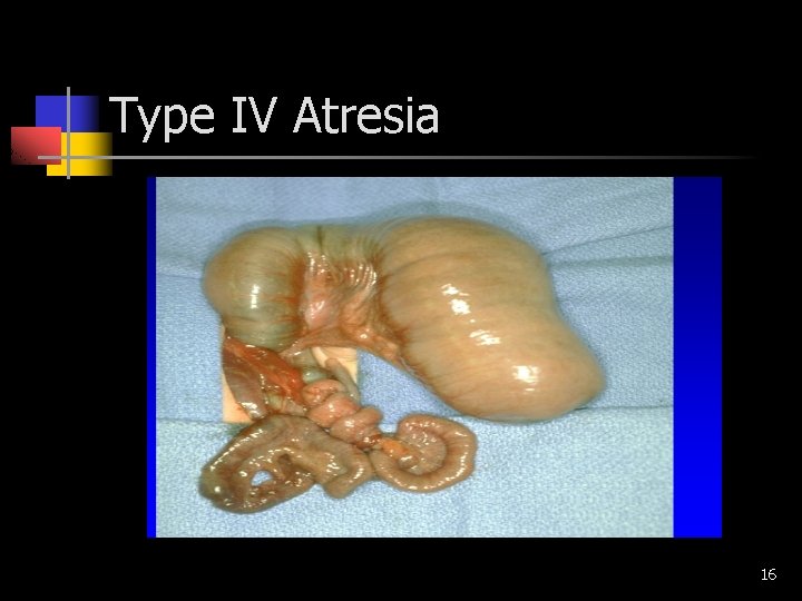 Neonatal intestinal obstruction General information Neonatal intestinal ...
