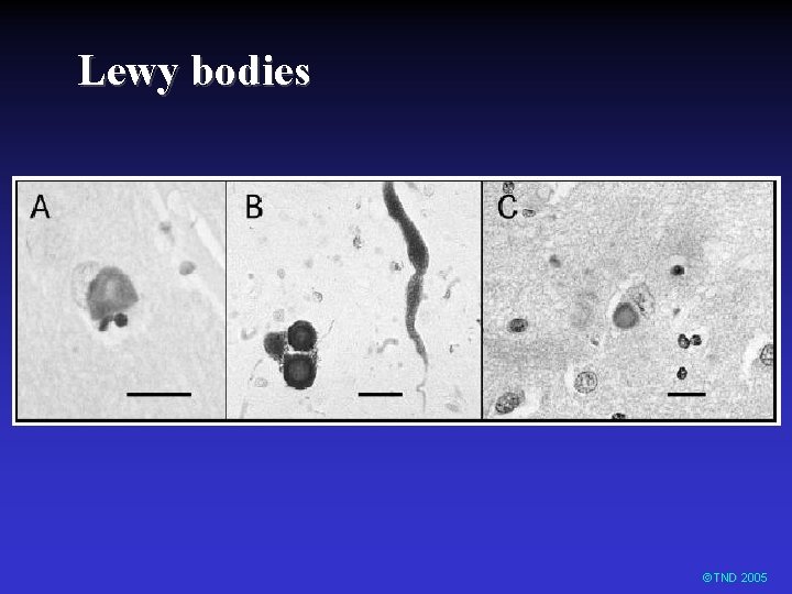 History of Parkinsons disease PD First described in