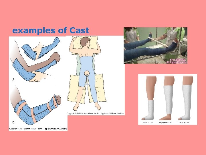 Mechanical Mobilization Fundamental Nursing Skills and Concepts Chapter