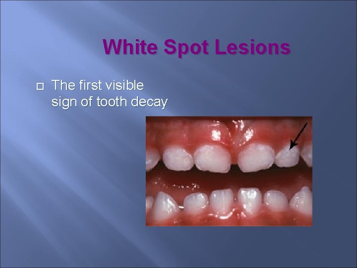 THE CARIES BALANCE WHAT CAUSES CAVITIES AND HOW