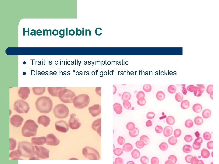 The Haemoglobinopathies l l l A range of