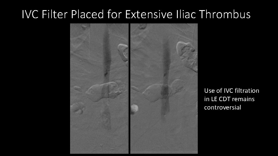 Catheter Based Treatment of DVT J Fritz Angle