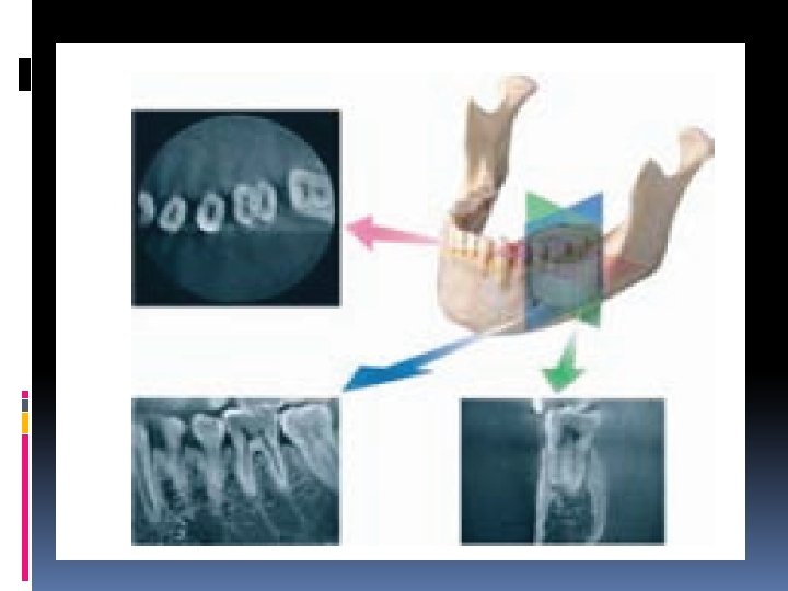 CBCT IN ENDODONTICS CBCT in endodontics 1 apical