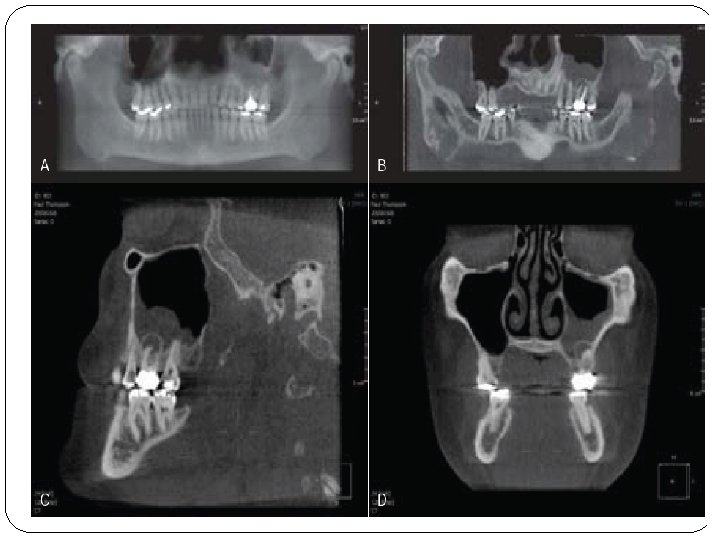 CBCT IN ENDODONTICS CBCT in endodontics 1 apical