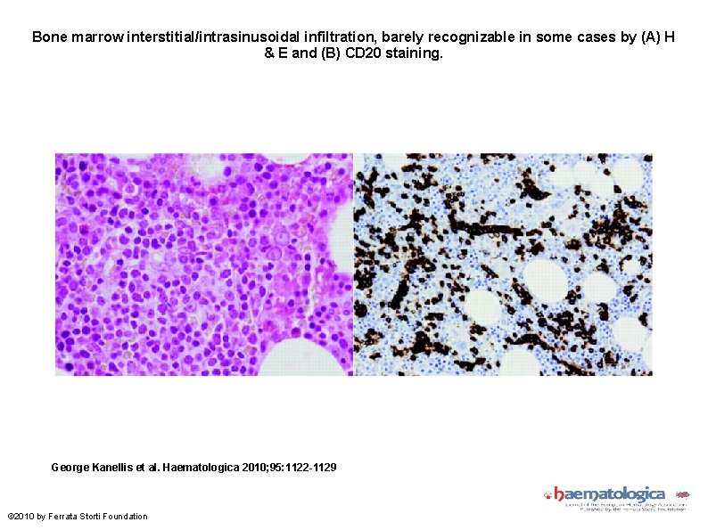 Splenic diffuse red pulp small Bcell lymphoma revision