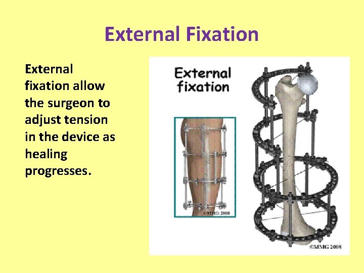 Bone Repair Challenge Biomedical Engineering External Fixation Temporary
