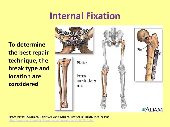 Bone Repair Challenge Biomedical Engineering External Fixation Temporary