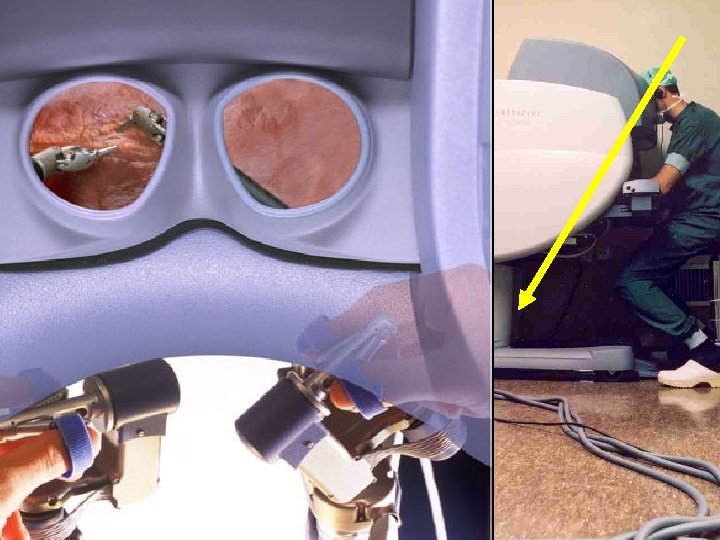 CHIRURGIA VIRTUALE TORS Trans Oral Robotic Surgery nellanziano