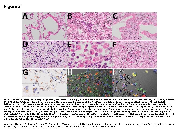 Figure 2 Pathologic findings for the lungs lymph
