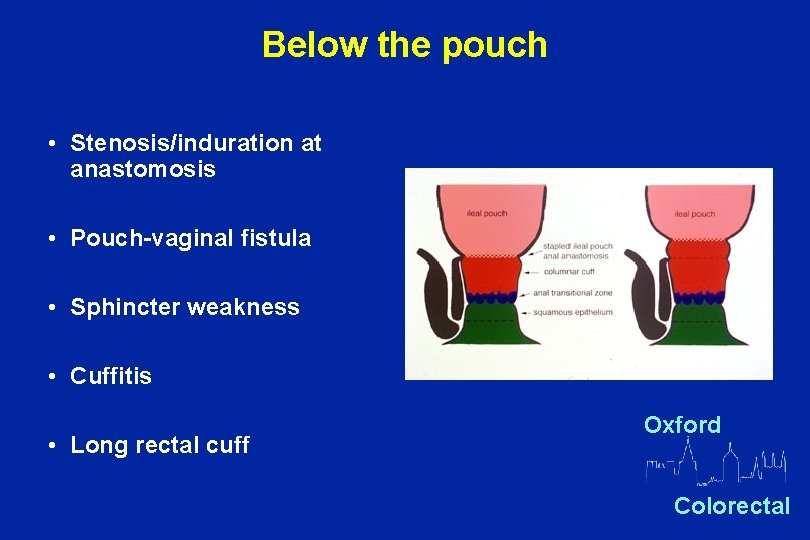 Management of the Problem Pouch Bruce George Oxford