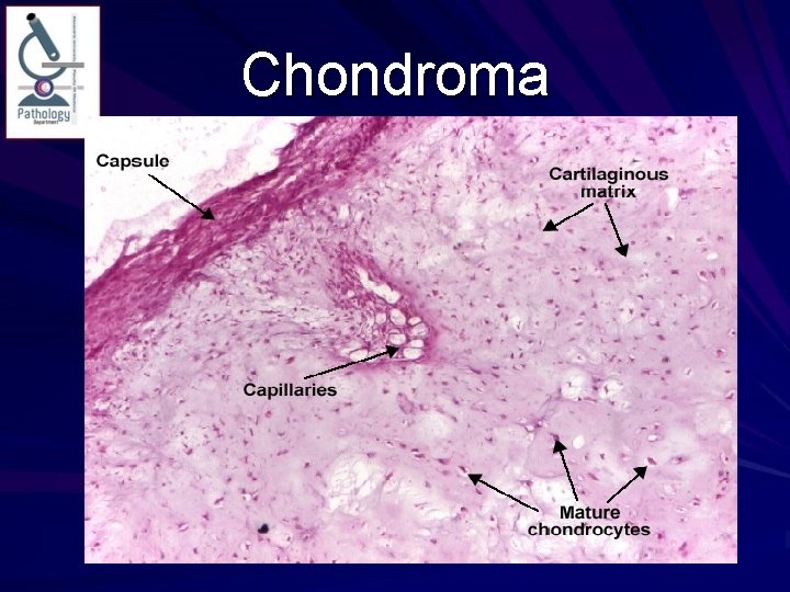 Bone Disorders LIST OF JARS Osteoma Skull Haemangioma