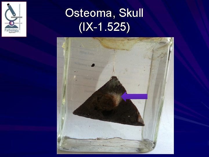 Bone Disorders LIST OF JARS Osteoma Skull Haemangioma