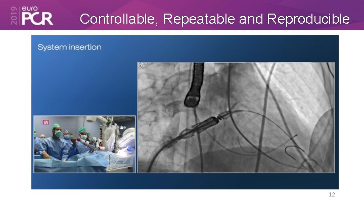 Cardiovalve Device Attributes Implant Procedure and Early Results