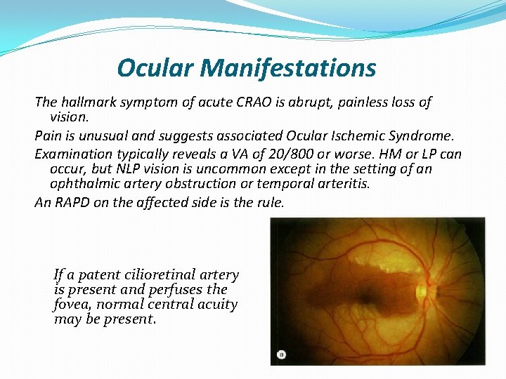 Central Retinal Artery Occlusion CRAO Dr Ramezani Assistant