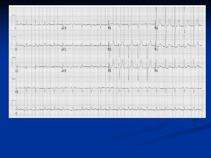 Supraventricular tachycardias n Definition tachycardia that originates from