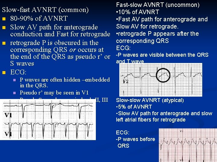 Supraventricular tachycardias n Definition tachycardia that originates from