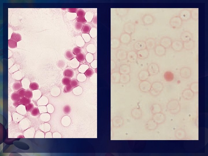 Practical Hematology Lab LAB 6 Hemoglobin F Stain