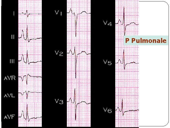 Elektrokardiografi EKG Normal Conduction System SA node Sumber