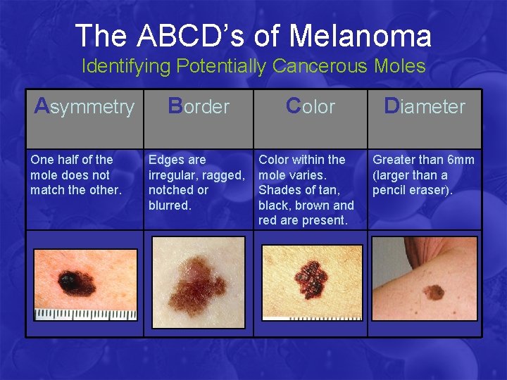 Identifying Potentially Cancerous Skin Lesions By Maria Kneusel