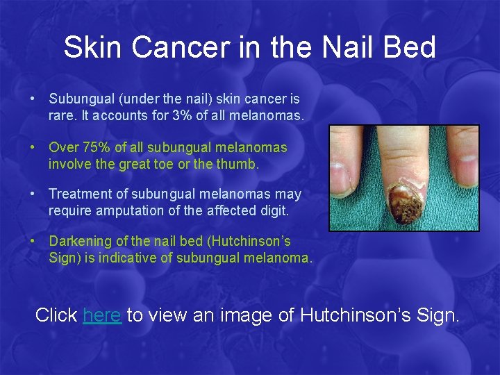 Identifying Potentially Cancerous Skin Lesions By Maria Kneusel