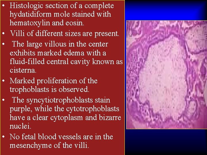 Hydatidiform Vesicular Mole Dr Ashraf Fouda Ob Gyn