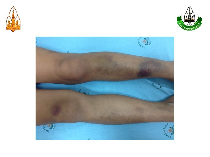 Laboratory Findings CBC Hb 12 gd L Hct
